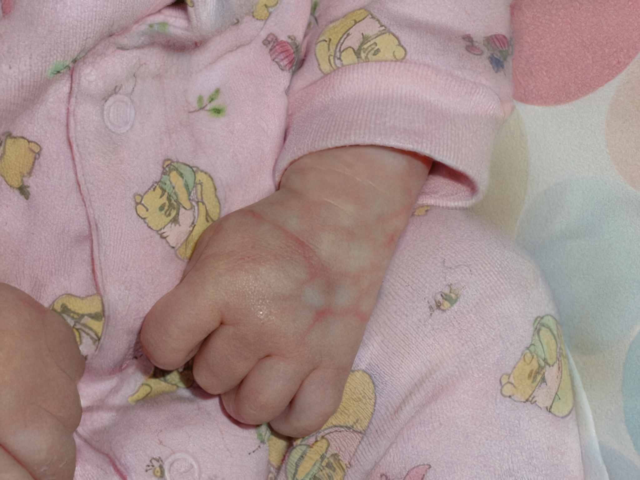 Mottled Skin in Babies: The Surprising Signs, Dangers, and When to Call ...